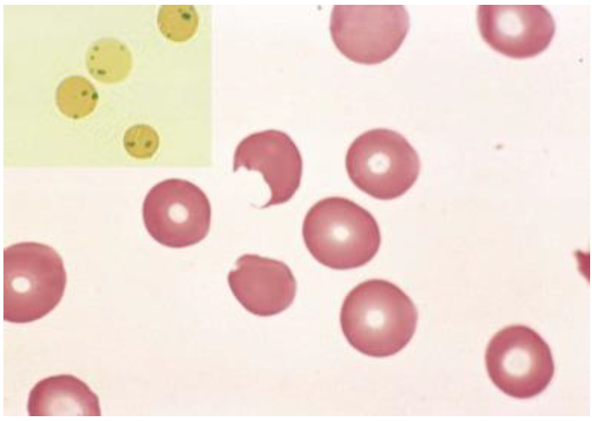 Anemia – Next Generation Combat Medic